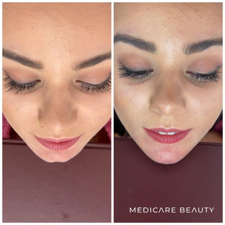 Kinn Unterspritzung bei Medicare Beauty