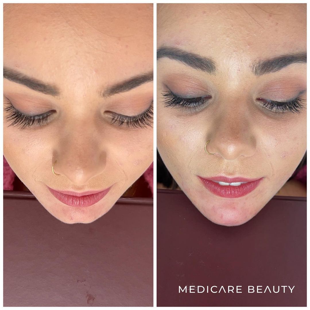 Kinn Unterspritzung bei Medicare Beauty